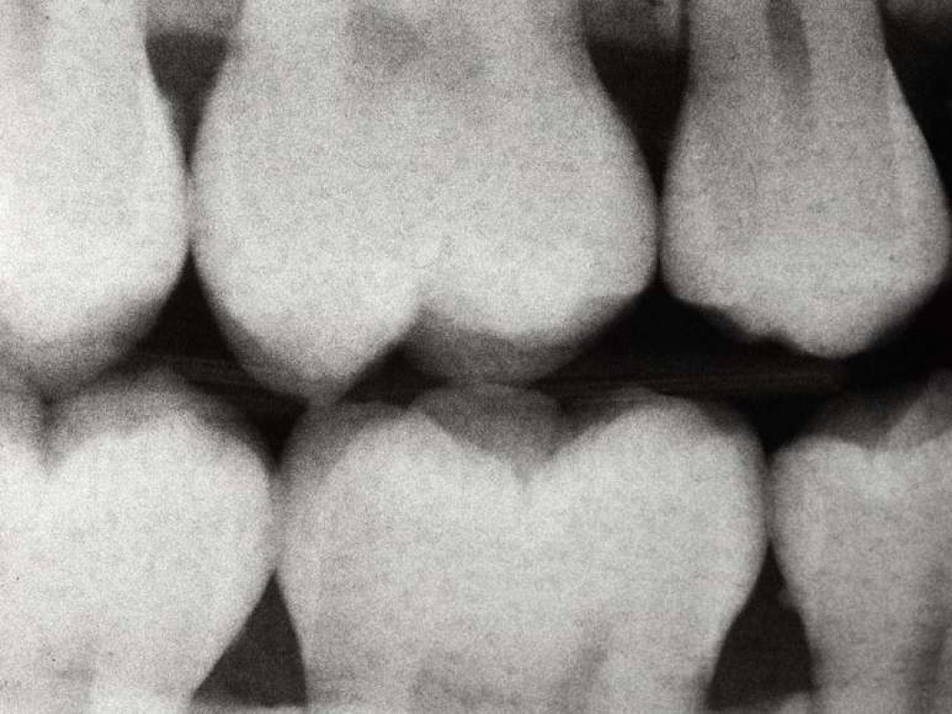 Periodontics | Broken Arrow, OK | Shoop Family Dentistry